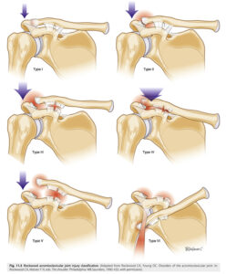 AC Joint Injuries - Zahab Ahsan, MD
